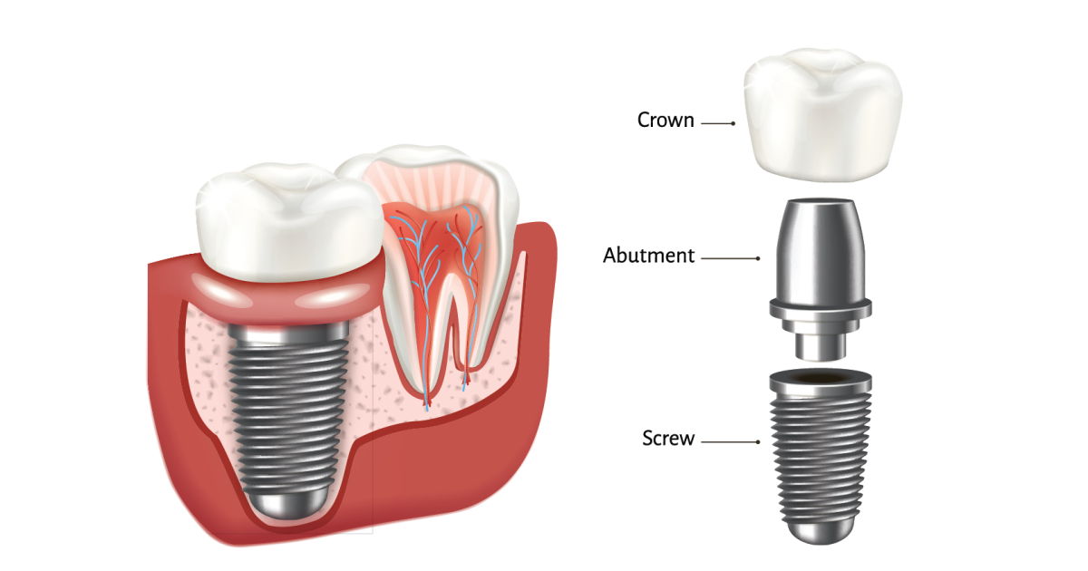 Dental Implants Offer Quality of Life | Vantedge Medical